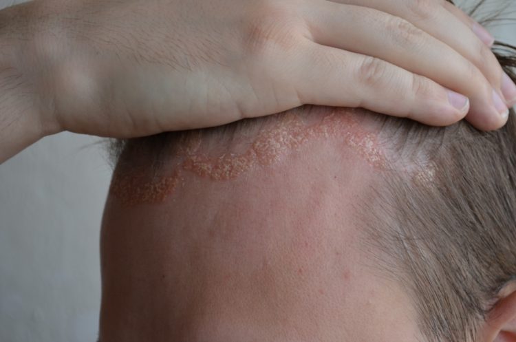 Psoriasis du cuir chevelu : traitements et conseils pratiques ...